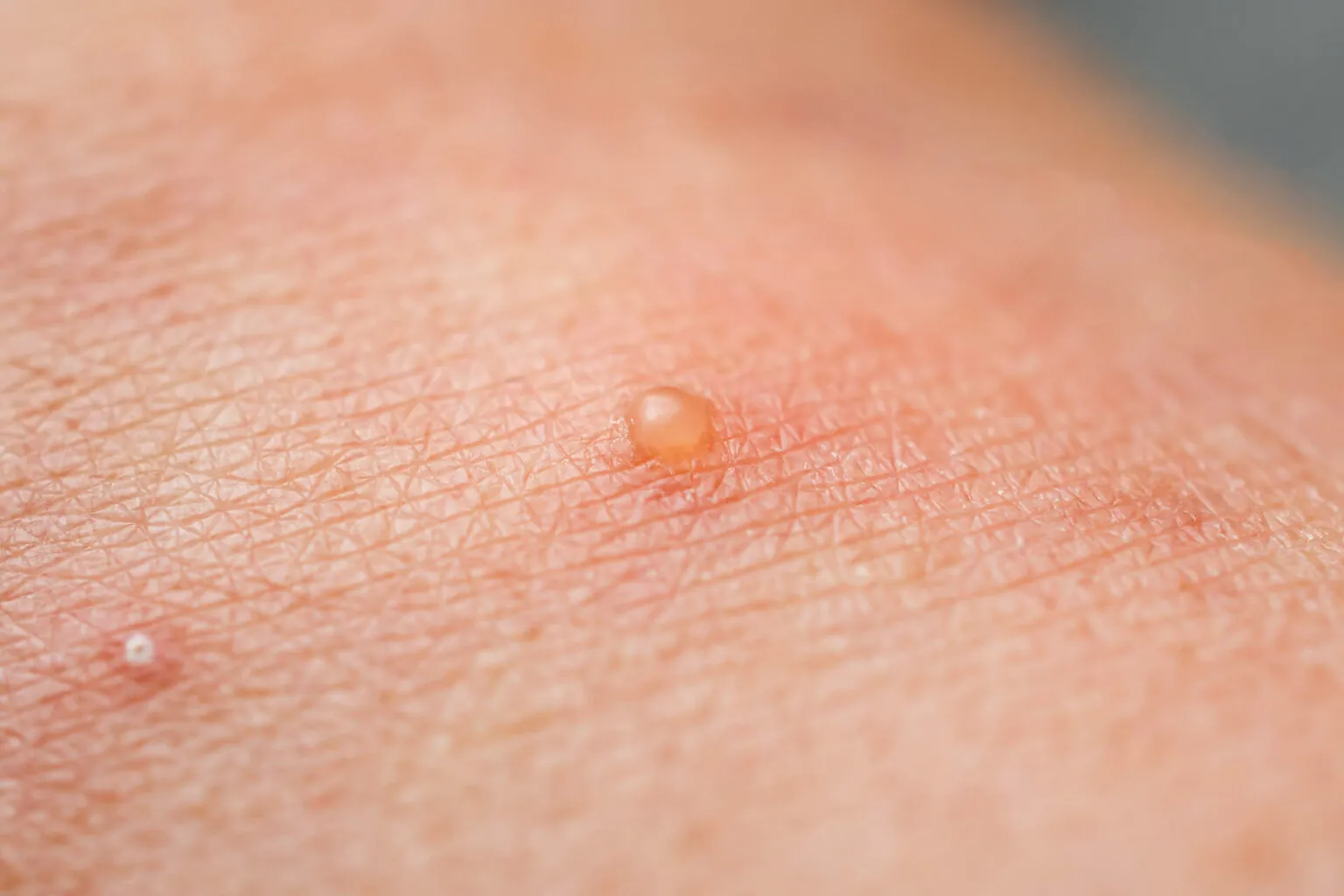 Molluscum Contagiosum Treatment for Kids and Adults in Omaha | Nebraska ...